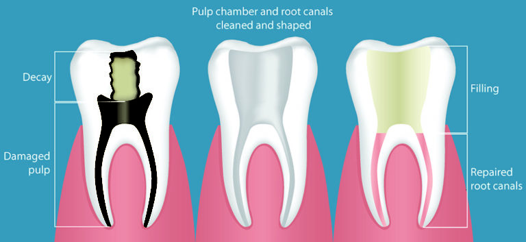 rct-procedure | The Dental Home
